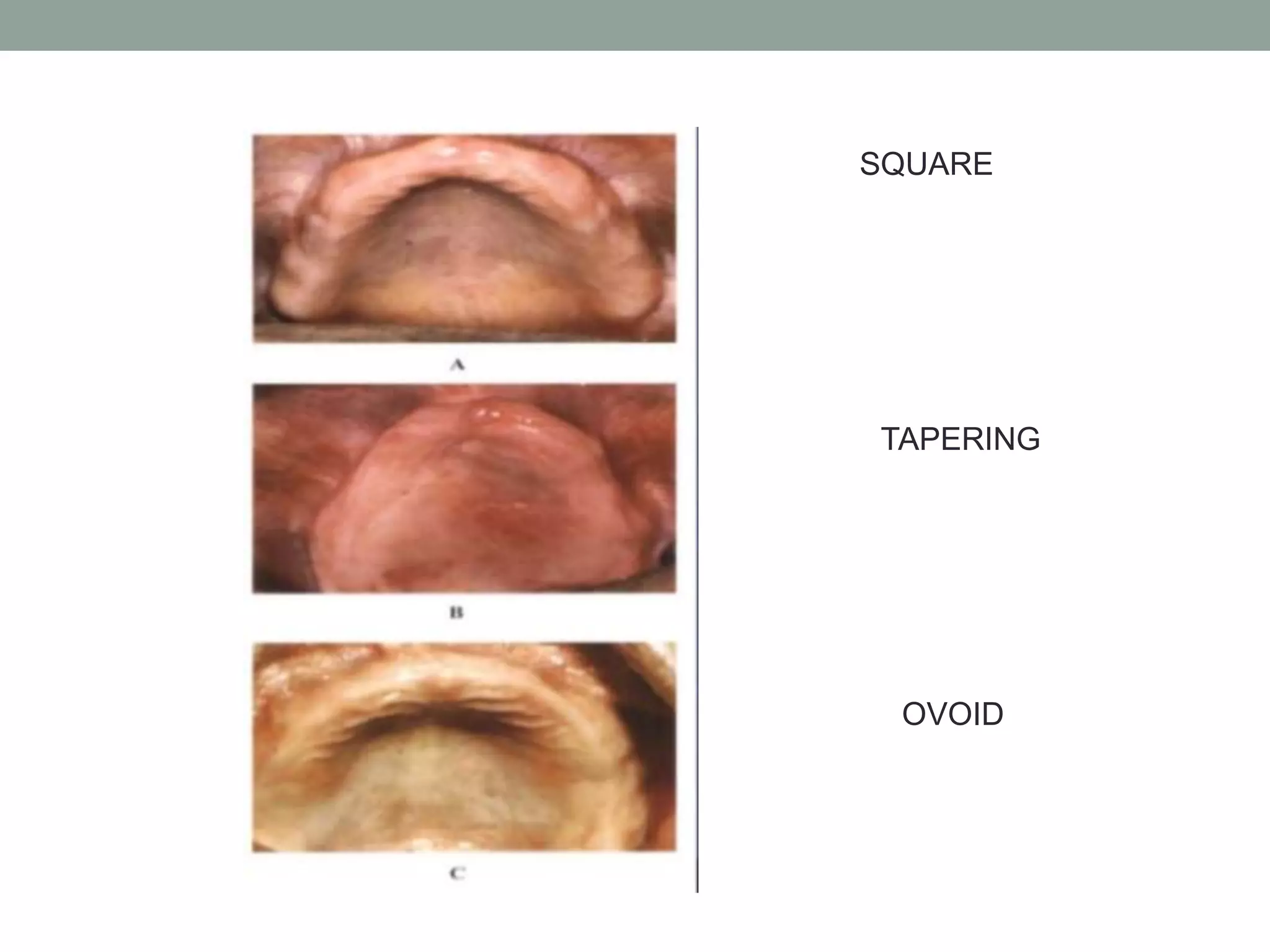 Complete denture case history | PPTX