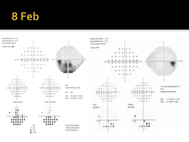Unilateral optic neuropathy? - the value of visual fields