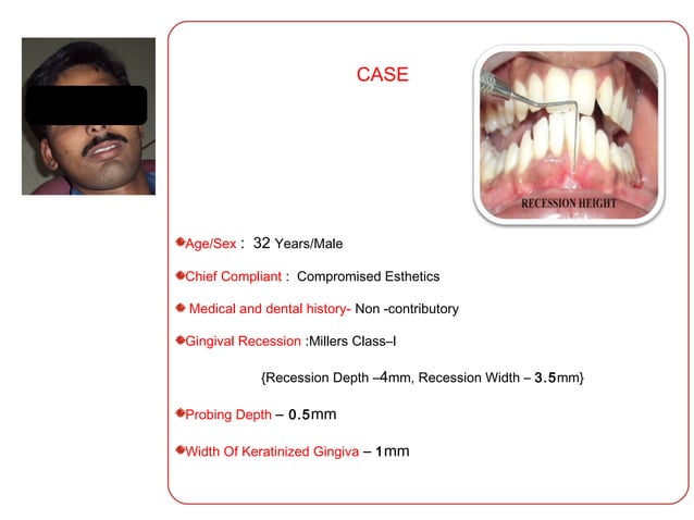 case report of Periosteal pedicle graft-novel technique | PPT