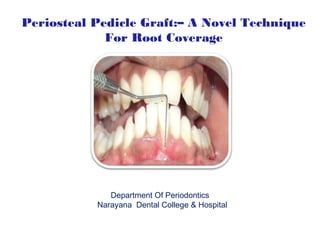 case report of Periosteal pedicle graft-novel technique | PPT