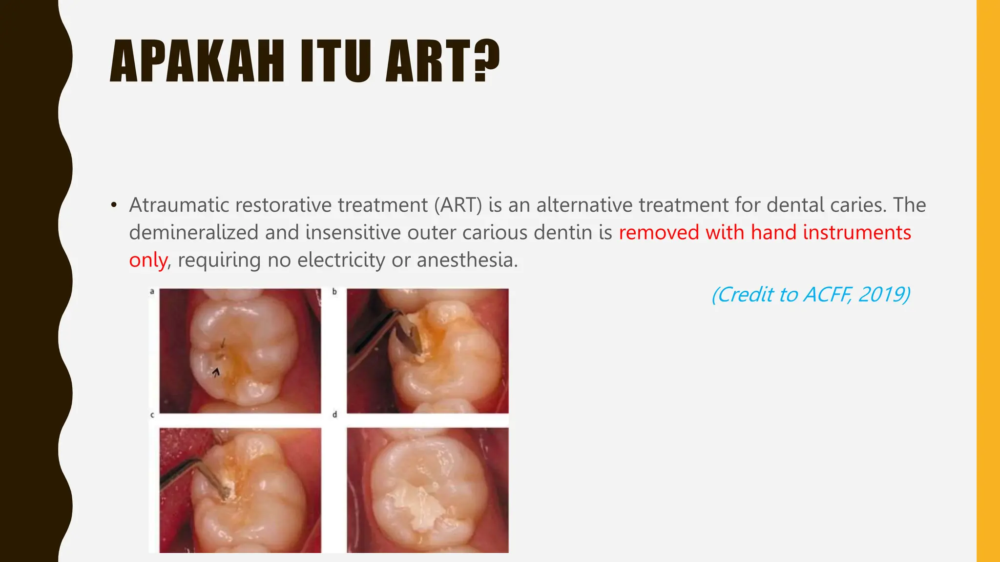 CDE- Arahan Kerja 4,9& 10 atraumatic restorative treatment.ppt