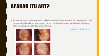 CDE- Arahan Kerja 4,9& 10 atraumatic restorative treatment.ppt