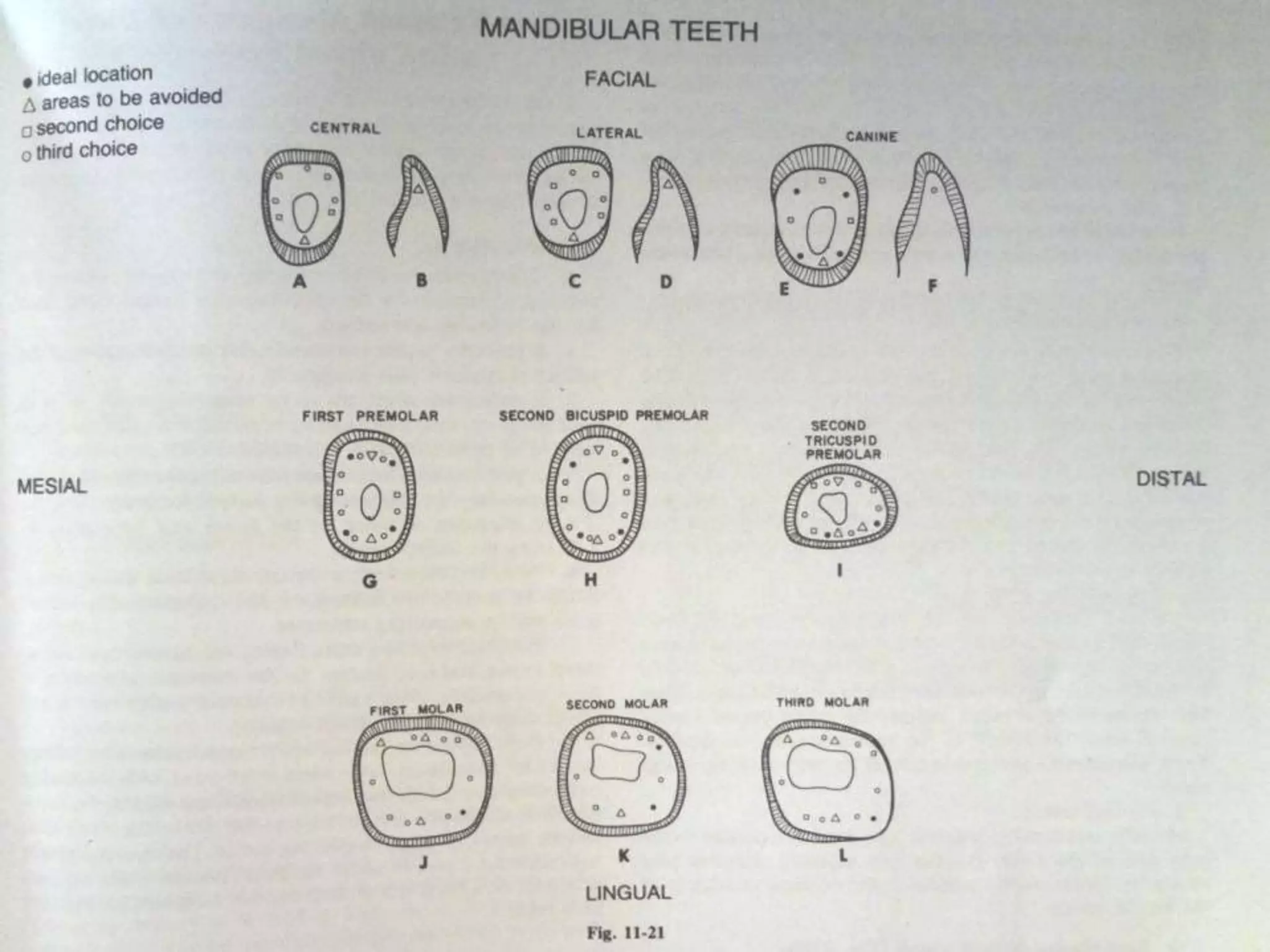 Pin Retained Restoration | PPTX