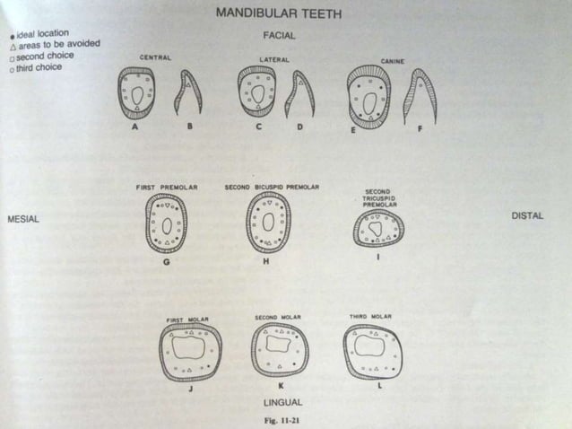 Pin Retained Restoration | PPTX | Dental Health | Diseases and Conditions