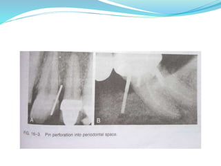 Pin Retained Restoration | PPTX