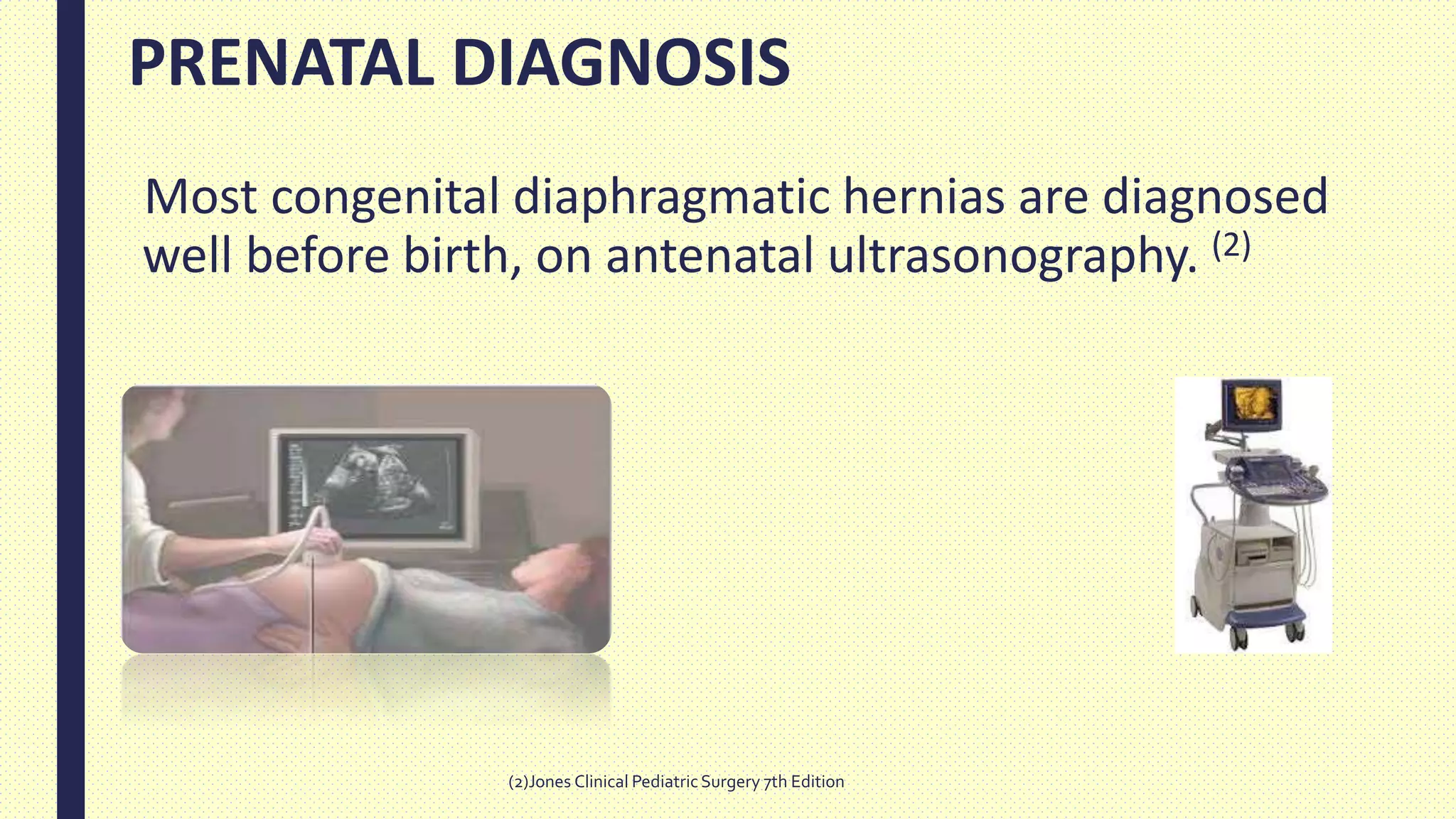 CONGENITAL DIAPHRAGMATIC HERNIA (CDH) | PPTX