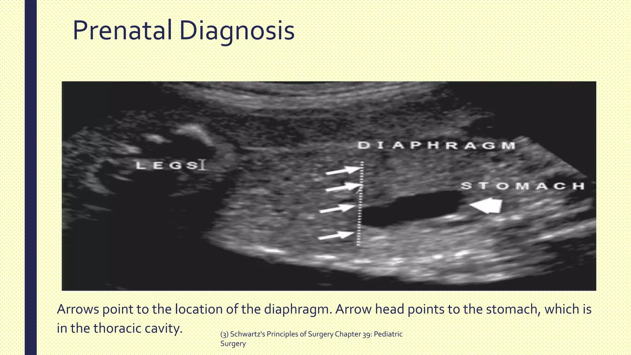 CONGENITAL DIAPHRAGMATIC HERNIA (CDH) | PPTX