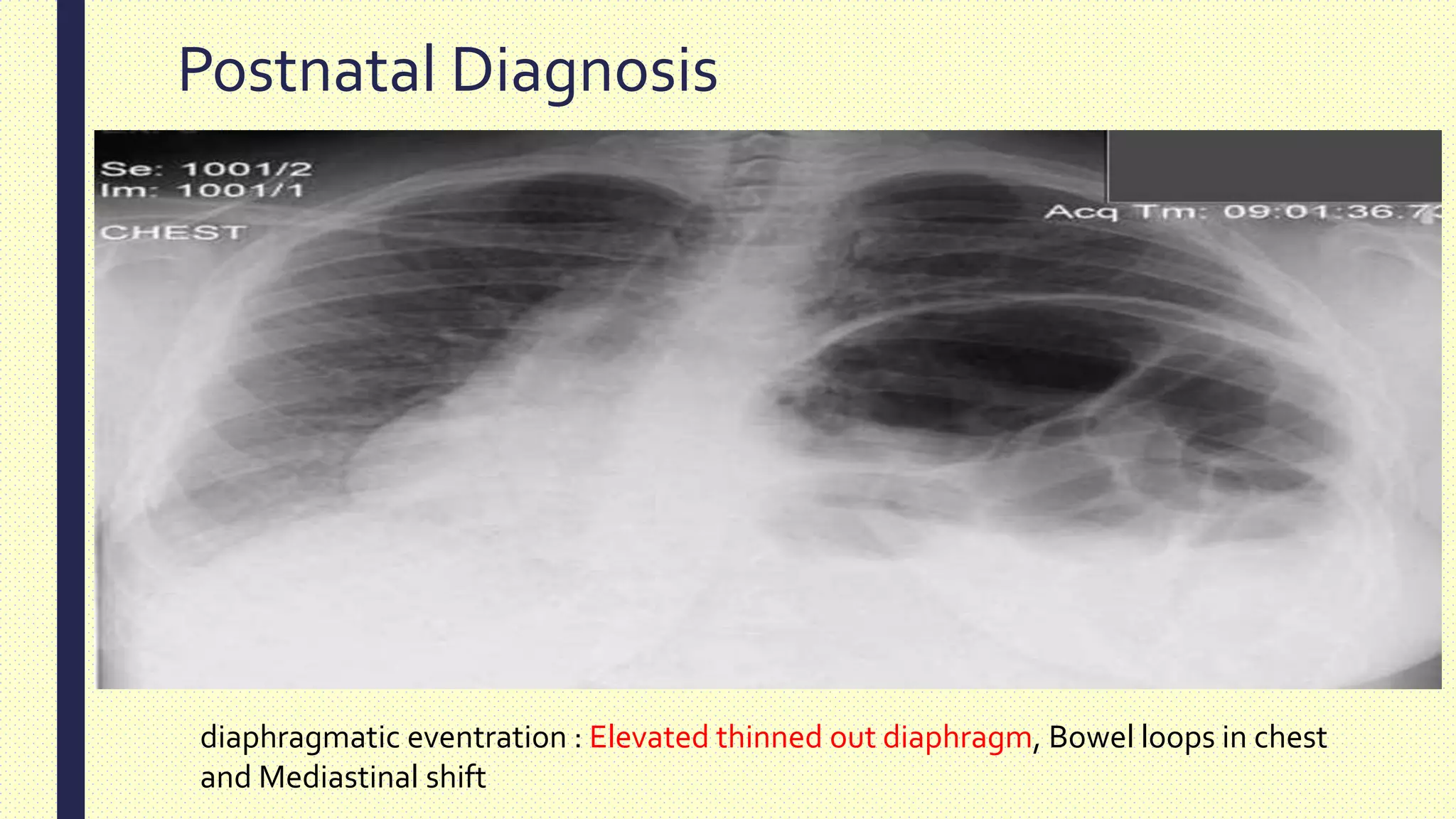 CONGENITAL DIAPHRAGMATIC HERNIA (CDH) | PPTX