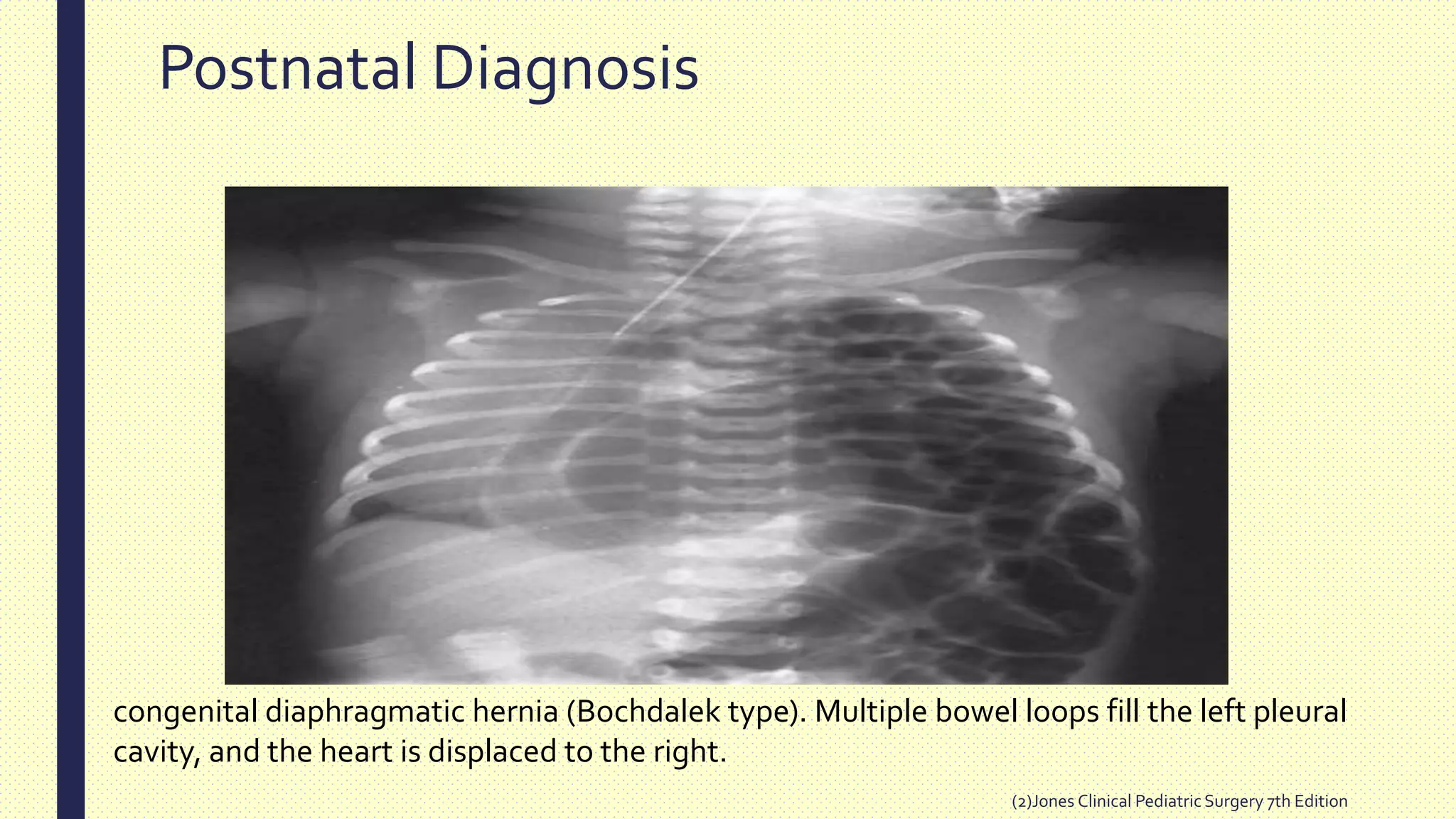 CONGENITAL DIAPHRAGMATIC HERNIA (CDH) | PPTX