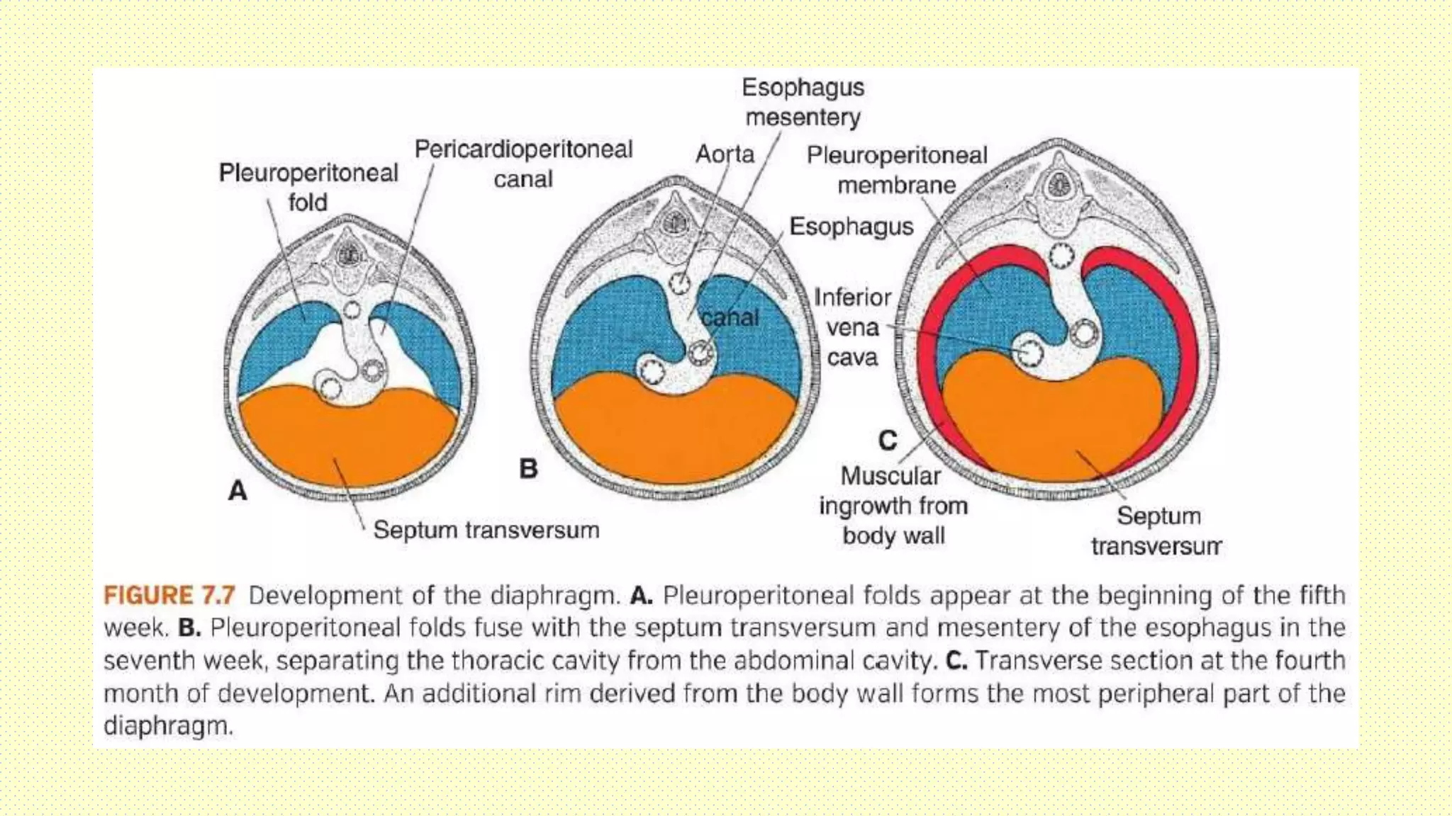 CONGENITAL DIAPHRAGMATIC HERNIA (CDH) | PPTX