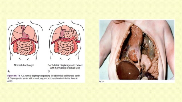 CONGENITAL DIAPHRAGMATIC HERNIA (CDH) | PPTX