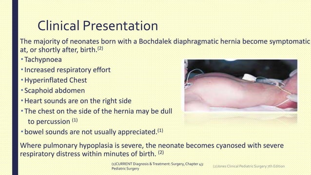 CONGENITAL DIAPHRAGMATIC HERNIA (CDH) | PPTX