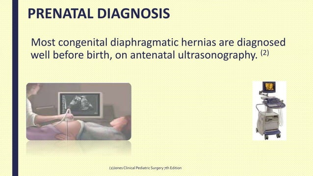 CONGENITAL DIAPHRAGMATIC HERNIA (CDH) | PPTX
