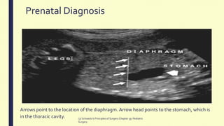 CONGENITAL DIAPHRAGMATIC HERNIA (CDH) | PPTX