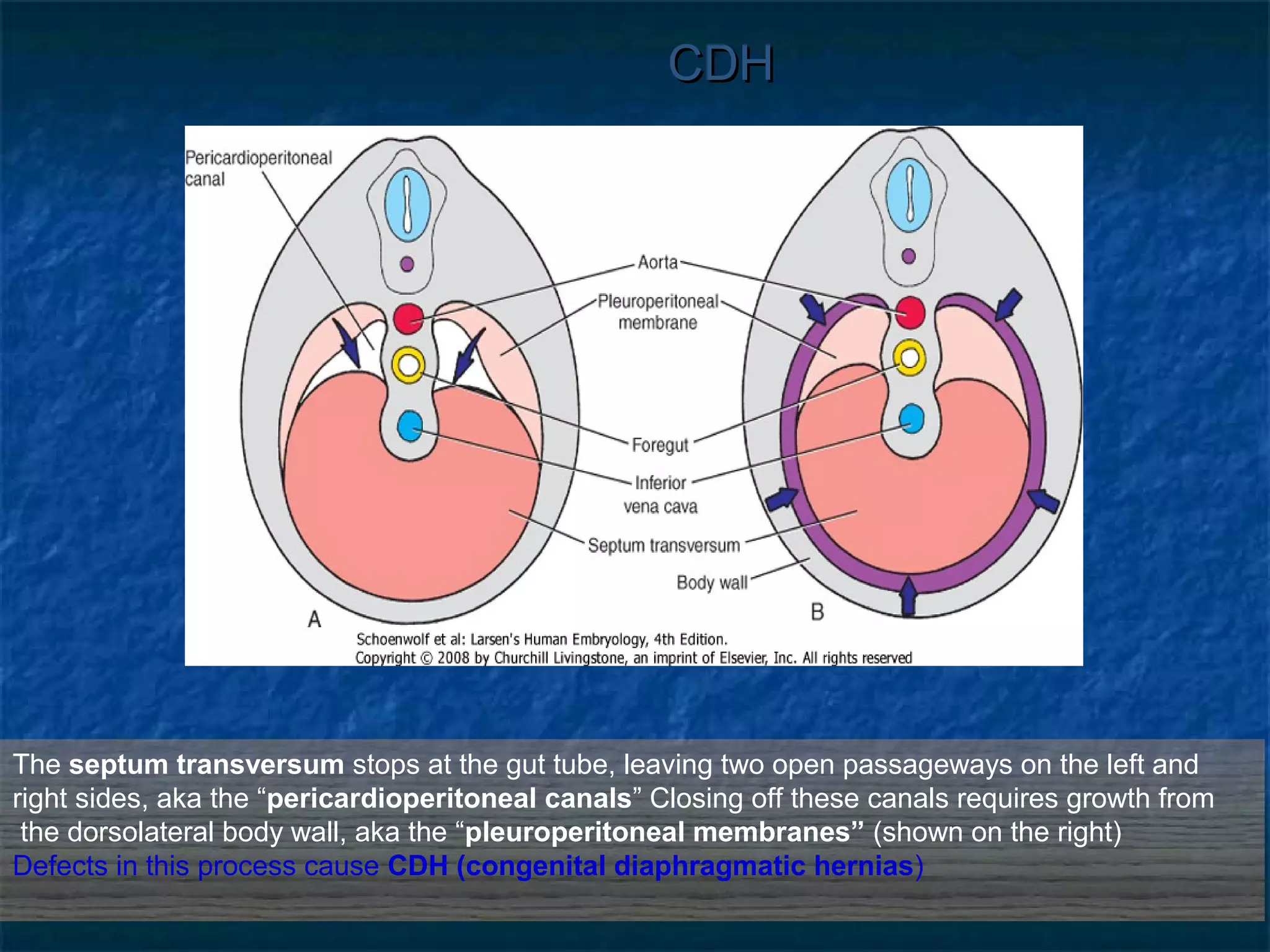 Congenital Diaphragmatic Hernia | PPT