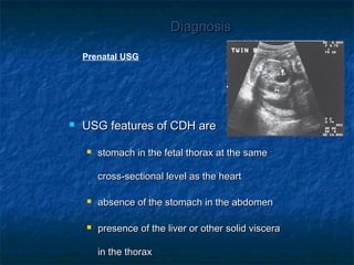 Congenital Diaphragmatic Hernia Ultrasound