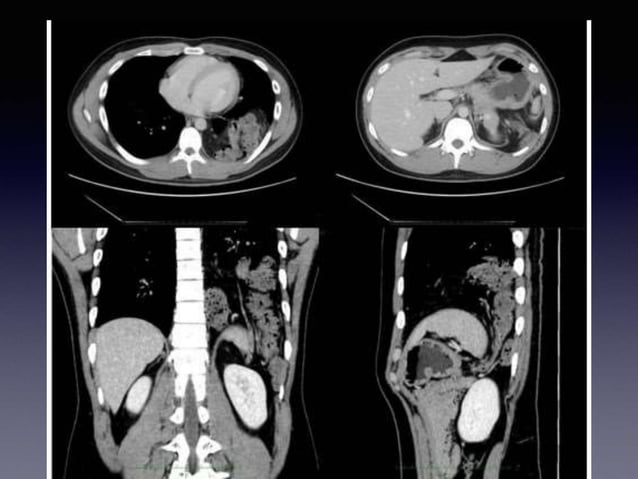 Congenital diaphragmatic hernia (CDH) | PPT | Pregnancy | Reproductive ...