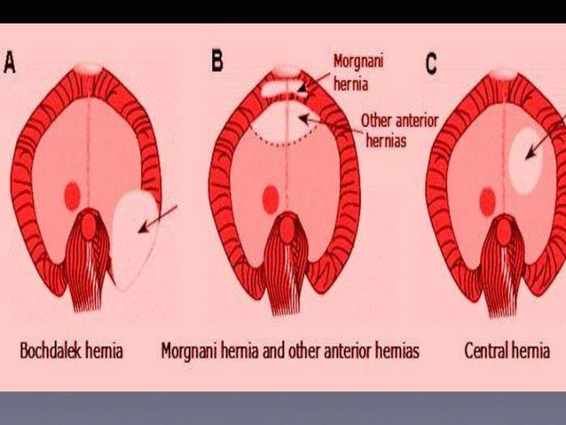 Congenital diaphragmatic hernia (CDH) | PPT | Pregnancy | Reproductive ...