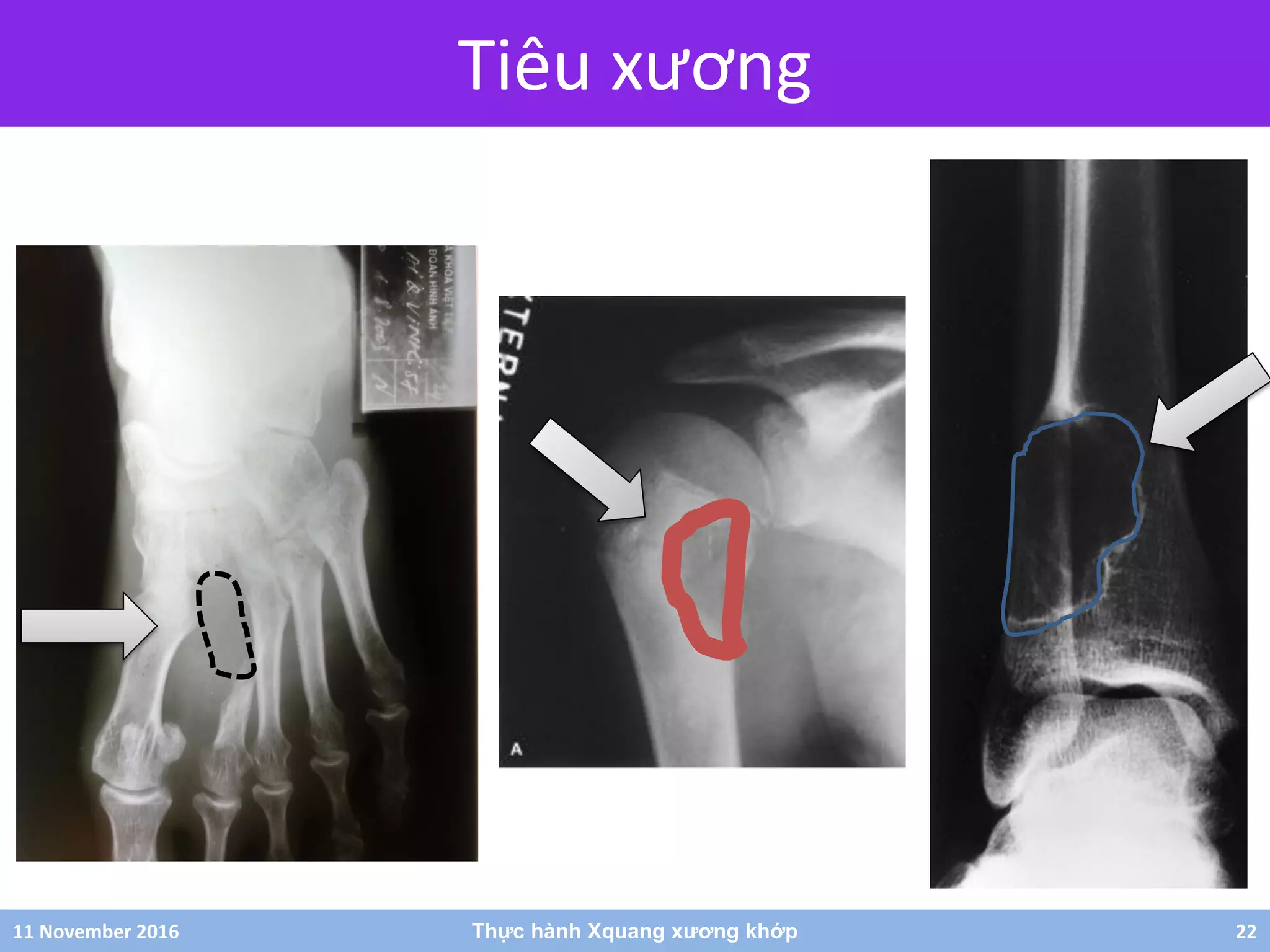 Thực hành X quang xương khớp | PDF