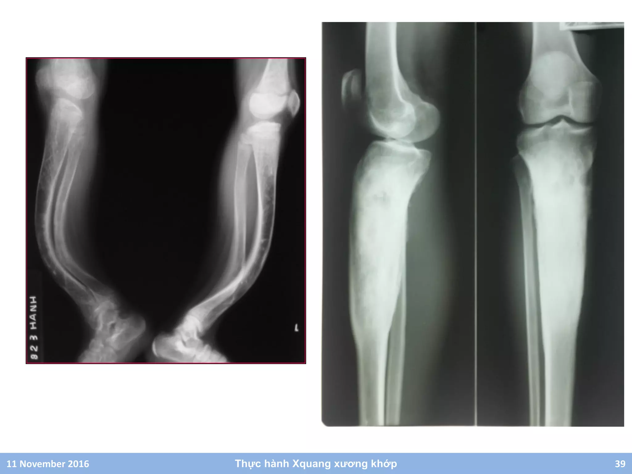 Thực hành X quang xương khớp | PDF