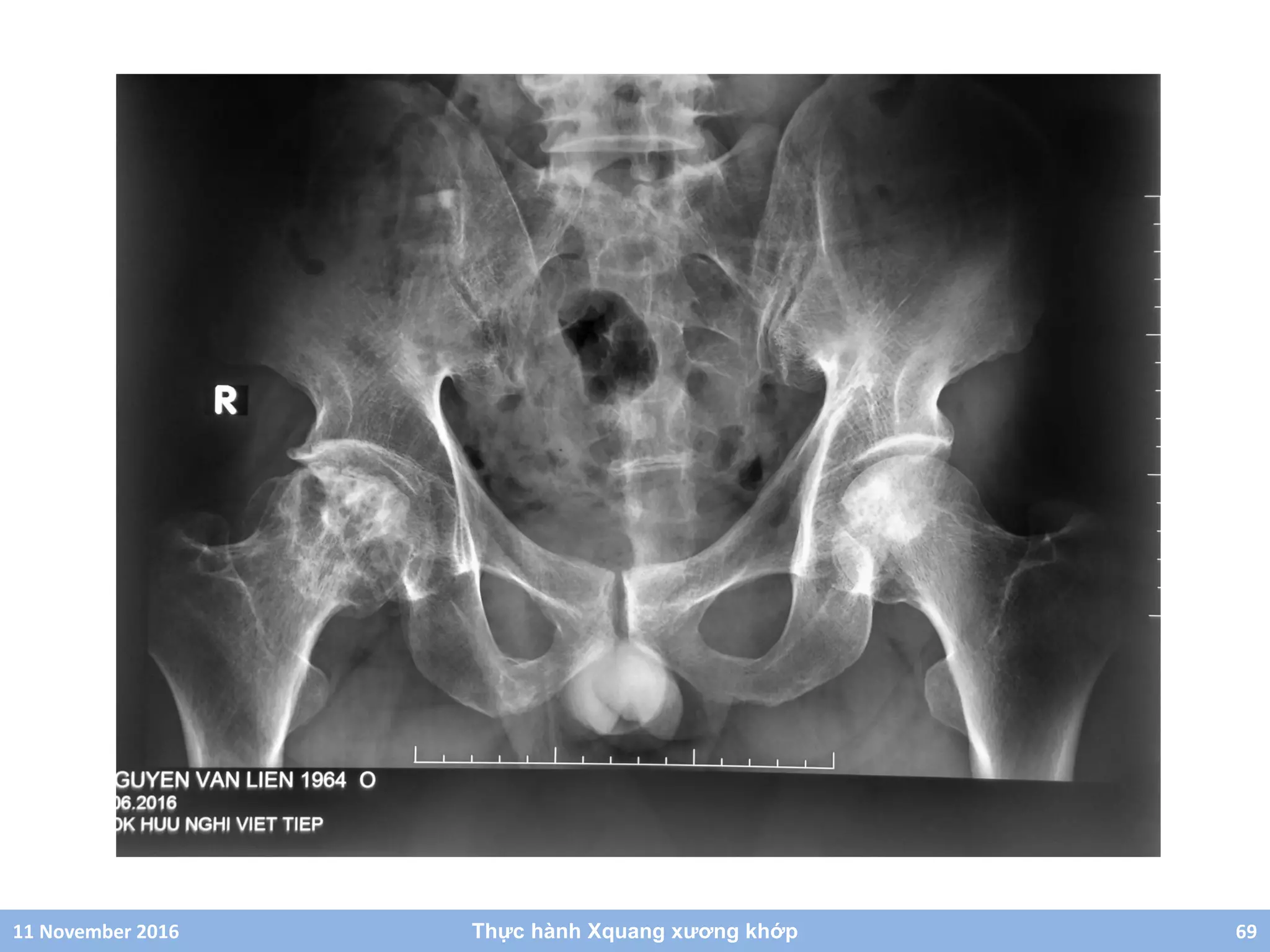 Thực hành X quang xương khớp | PDF