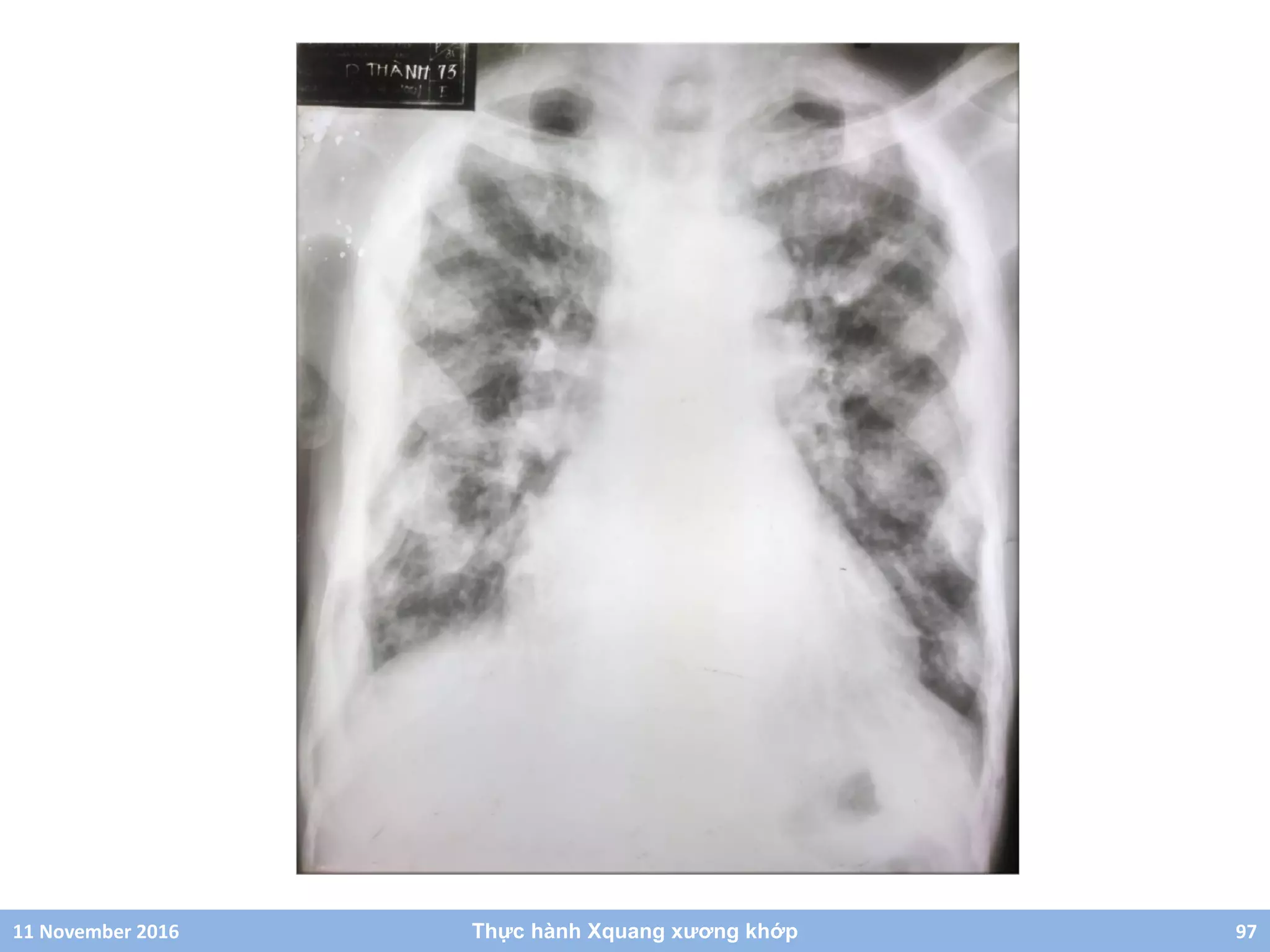 Thực hành X quang xương khớp | PDF