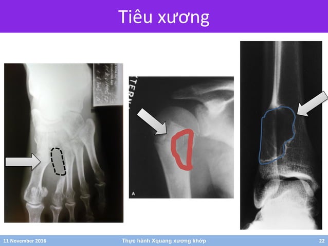 Thực hành X quang xương khớp | PDF