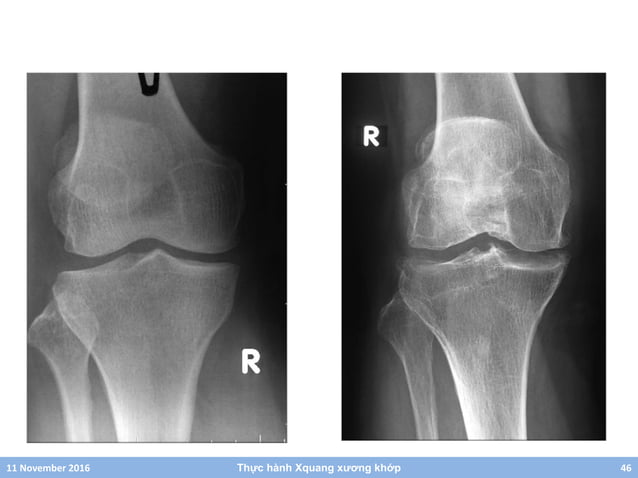 Thực hành X quang xương khớp | PDF