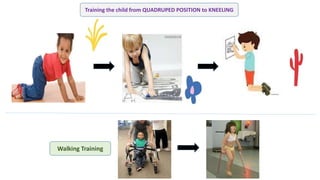 Congenital Dislocation of the Hip - PHYSIOTHERAPY | PPTX