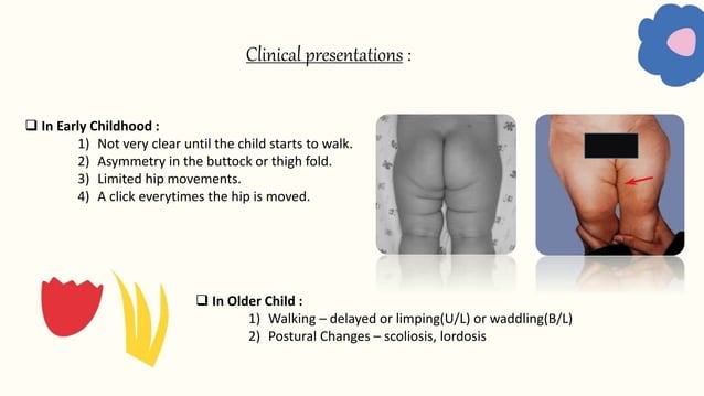 Congenital Dislocation of the Hip - PHYSIOTHERAPY | PPTX | Death, Injury, or Military Conflict ...