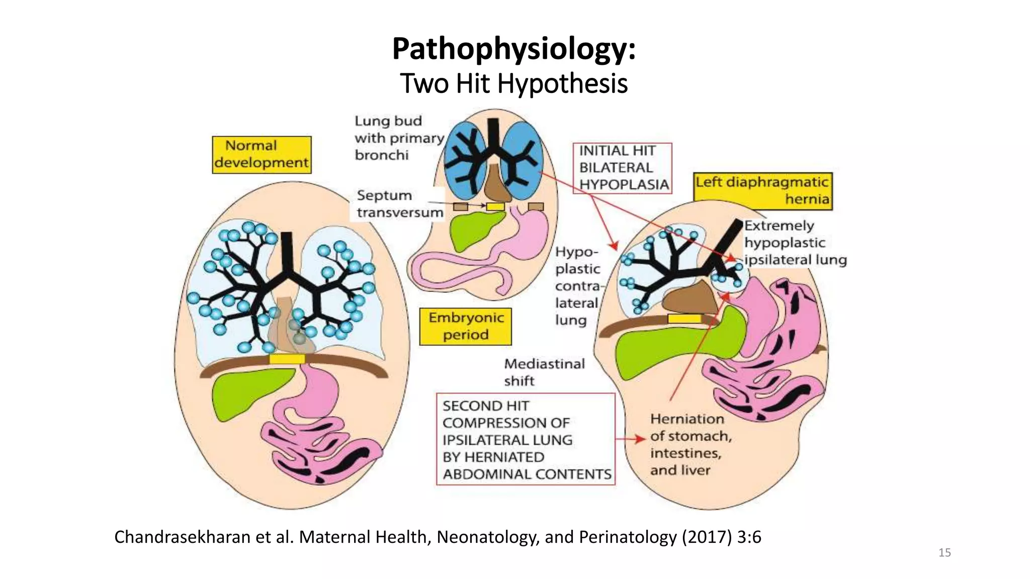 Anesthesia For Congenital Diaphragmatic Hernia | PPTX