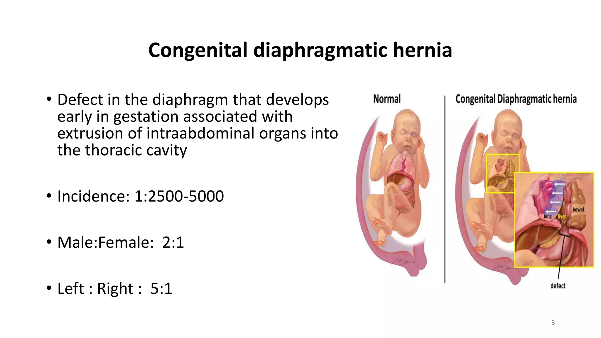 Anesthesia For Congenital Diaphragmatic Hernia | PPTX
