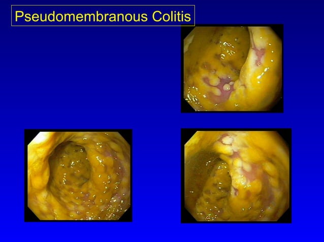 Clostridium difficile: C. diff is more difficult than ever ...