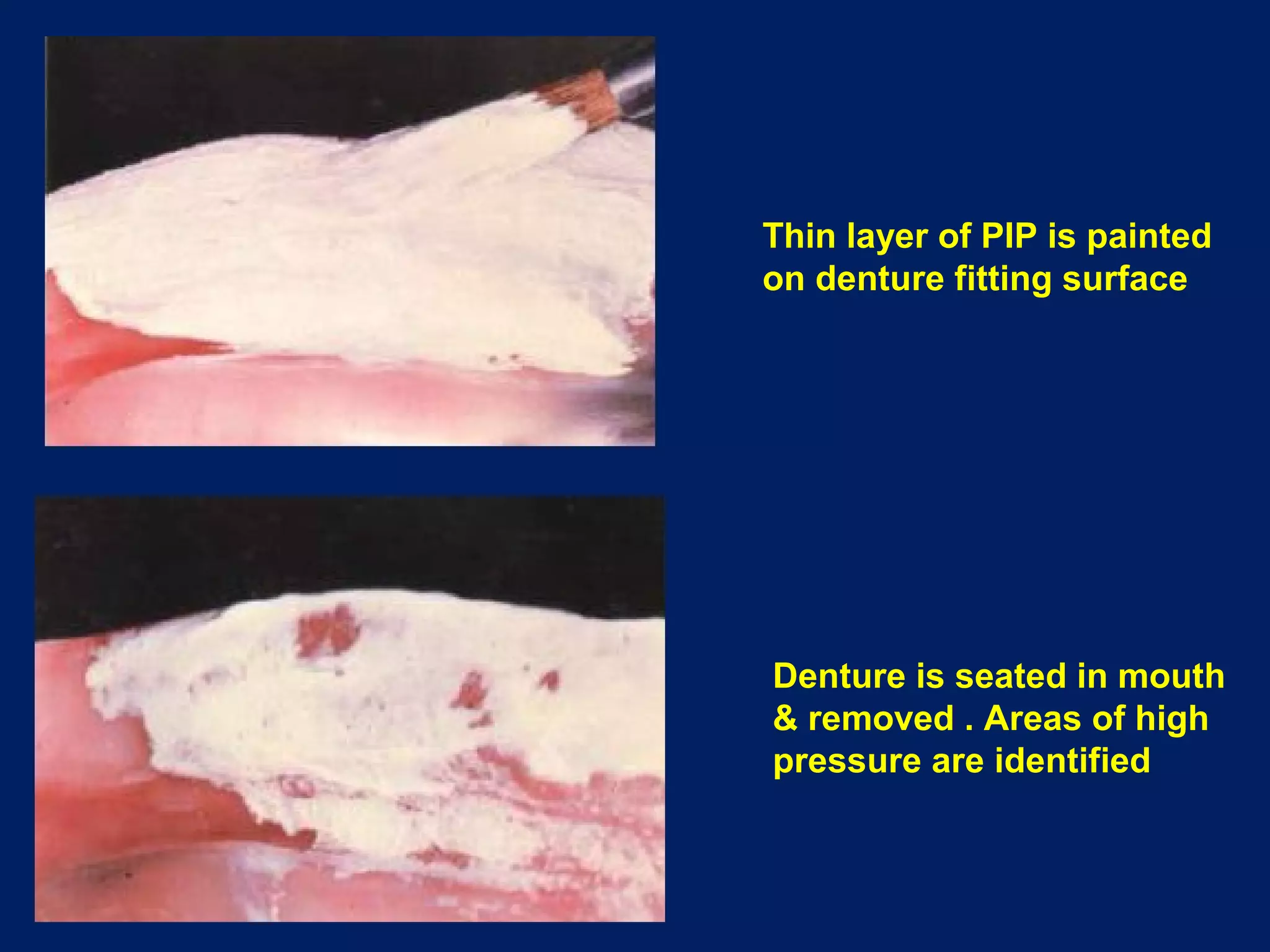 Complete Denture insertion | PPT