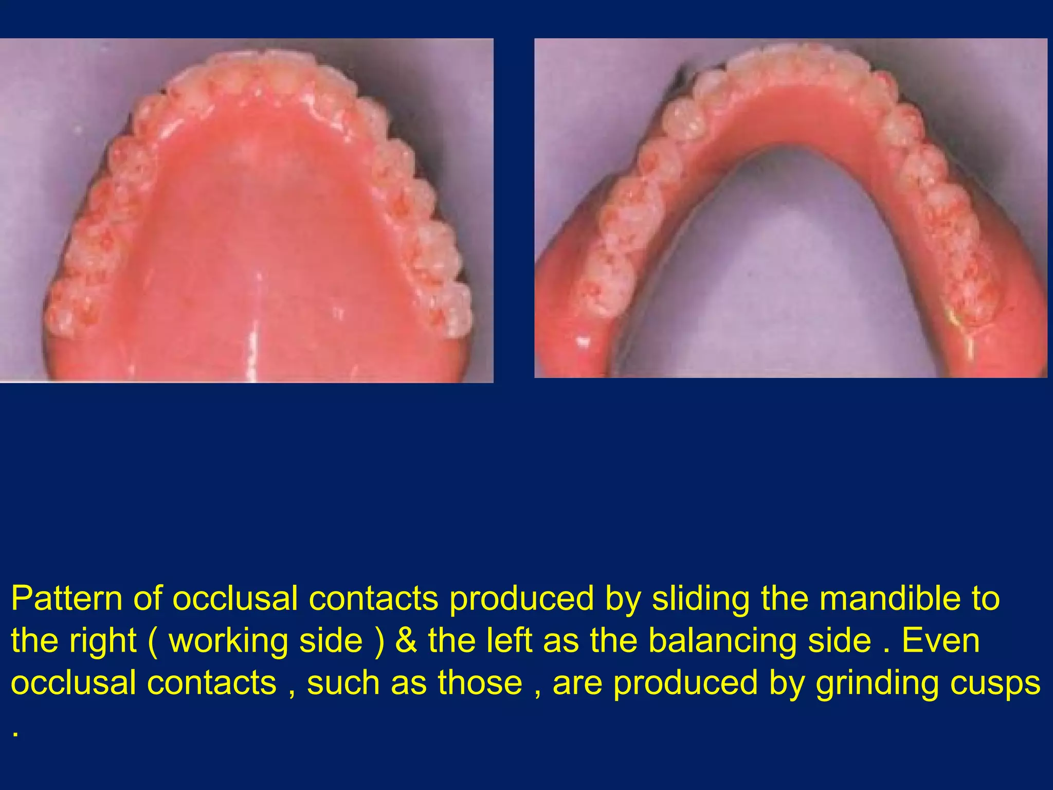 Complete Denture insertion | PPT