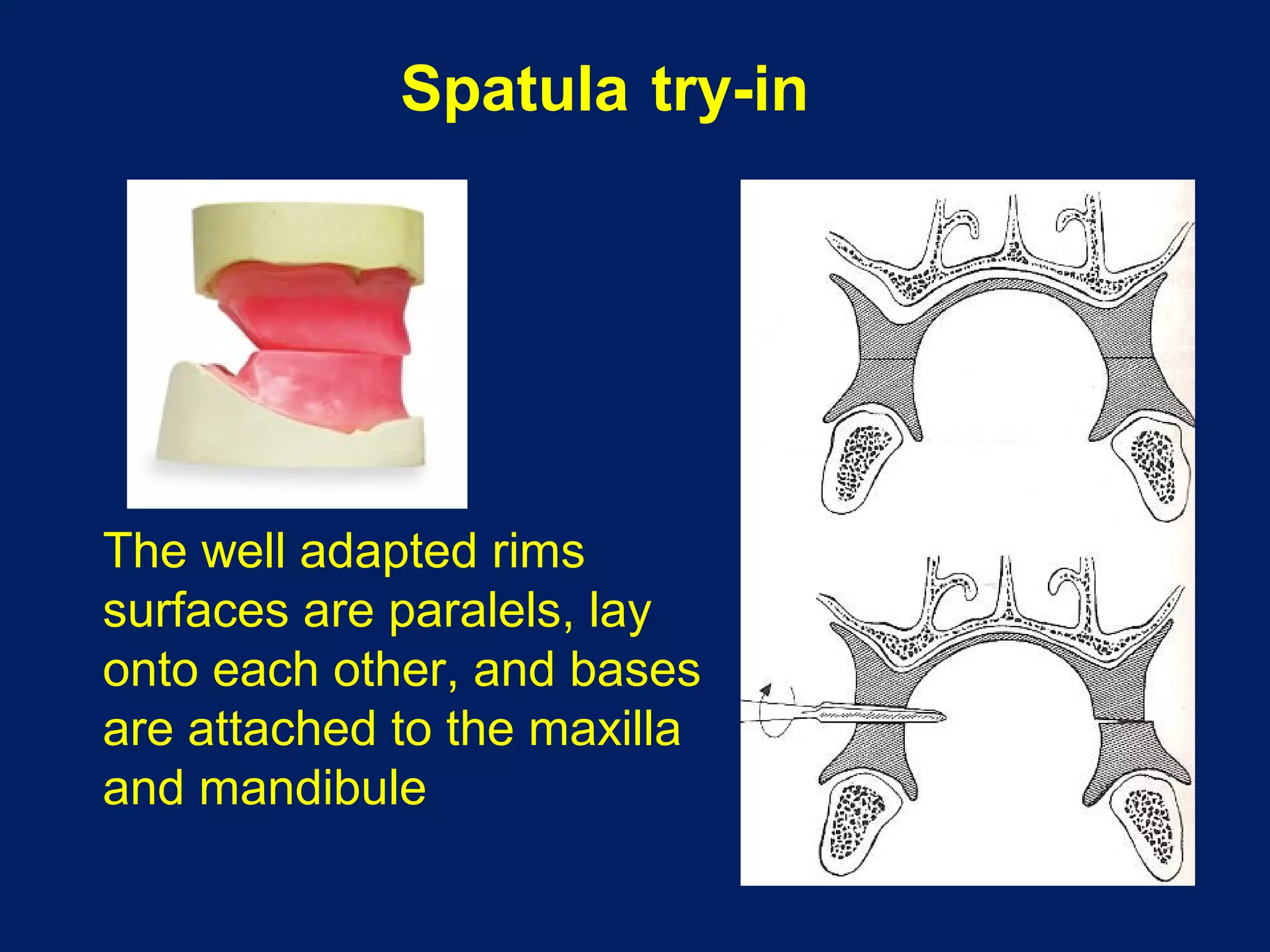 Complete Denture insertion | PPT
