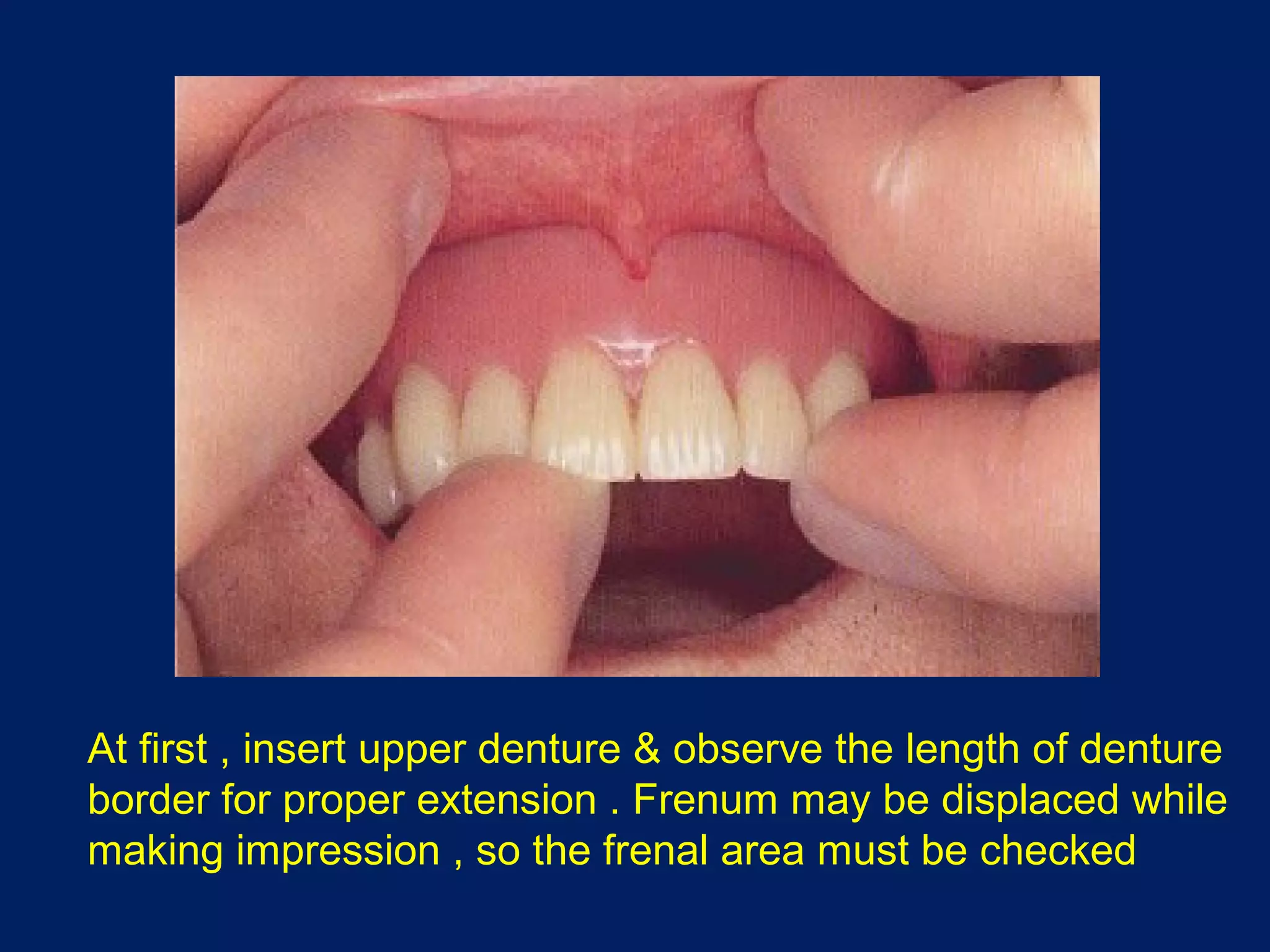 Complete Denture insertion | PPT