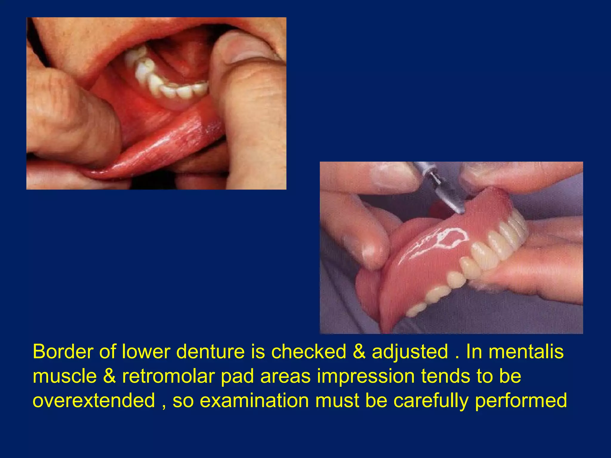 Complete Denture insertion | PPT