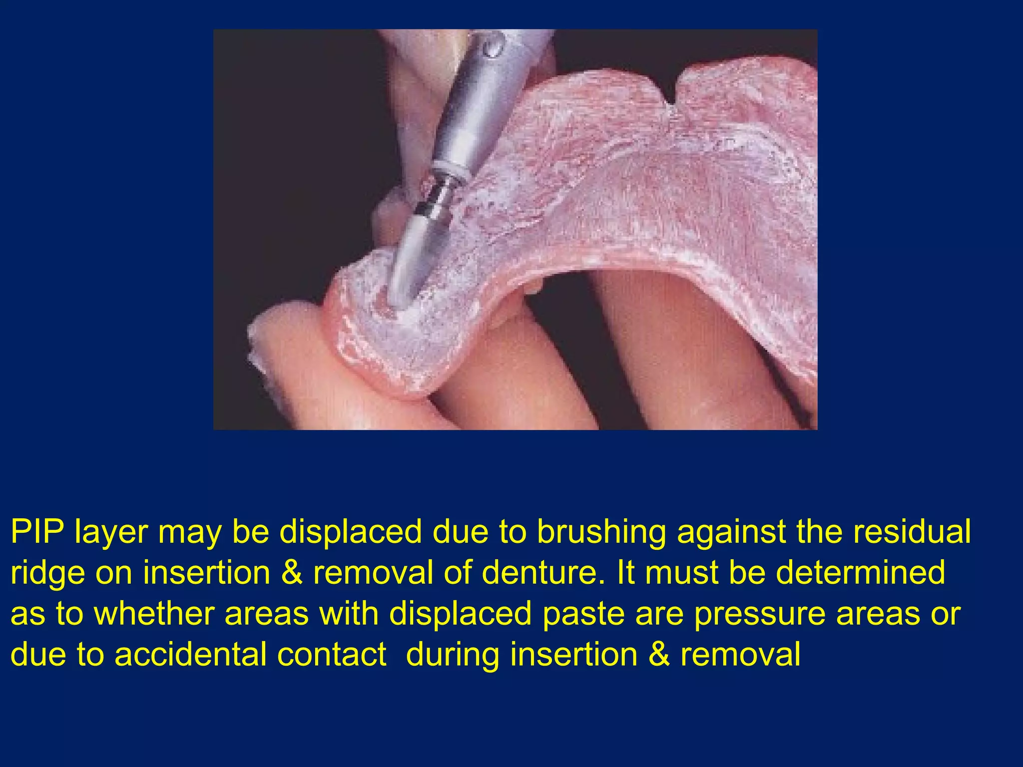 Complete Denture insertion | PPT