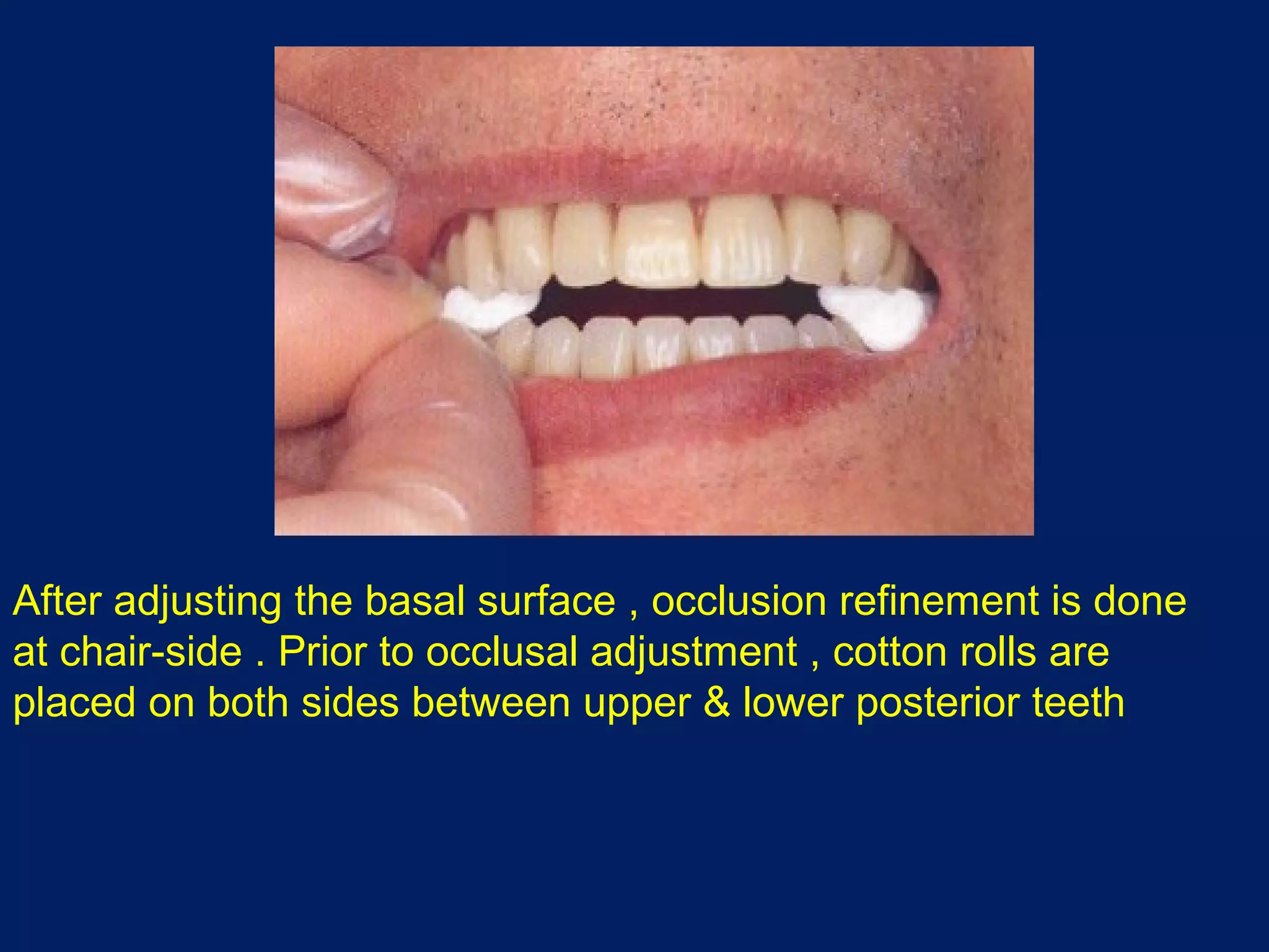 Complete Denture insertion | PPT