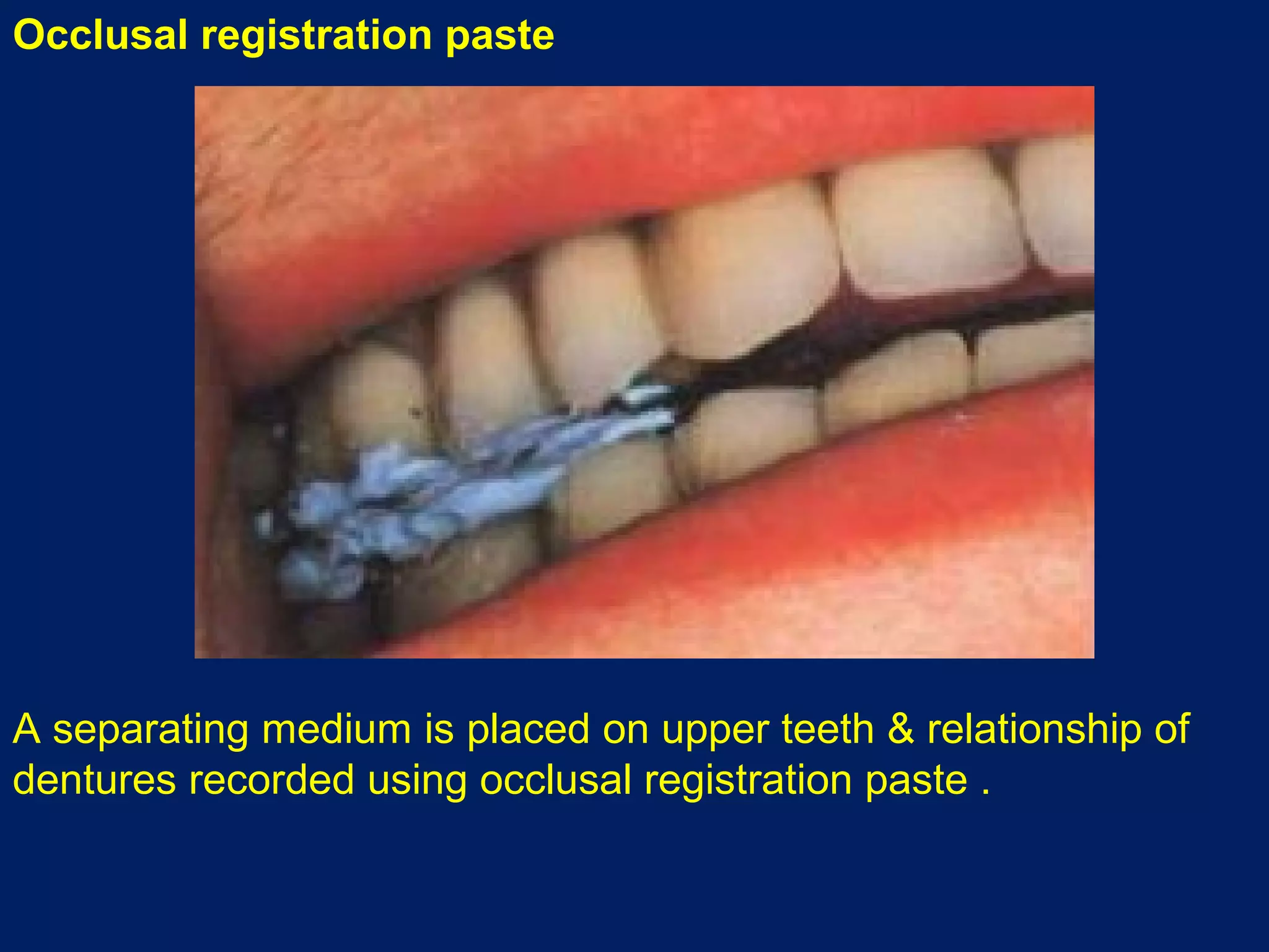 Complete Denture insertion | PPT