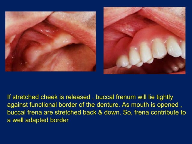 Complete Denture insertion | PPT