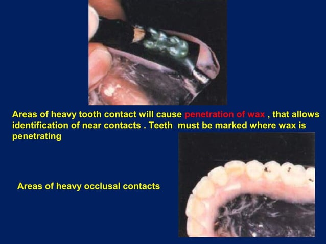 Complete Denture insertion | PPT