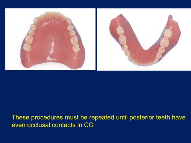 Complete Denture insertion | PPT