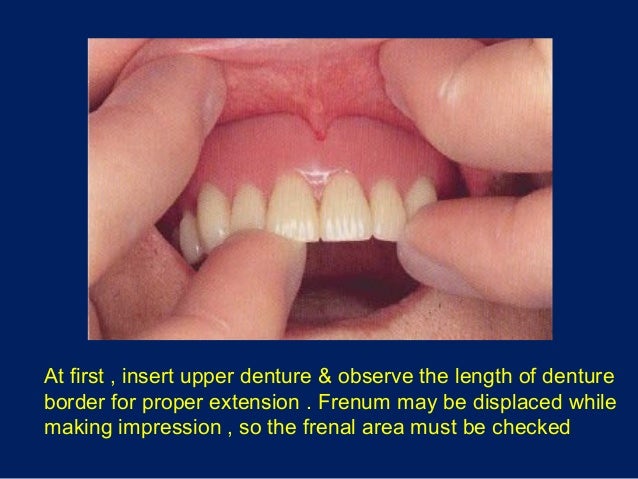 Complete Denture insertion