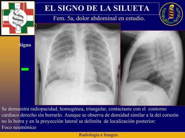 EL SIGNO DE LA SILUETA