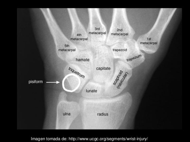 RADIOGRAFIA CARPAL