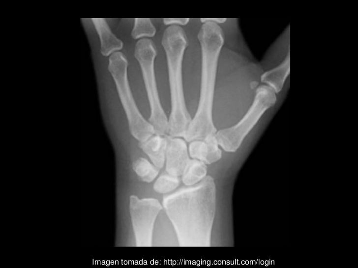 RADIOGRAFIA CARPAL