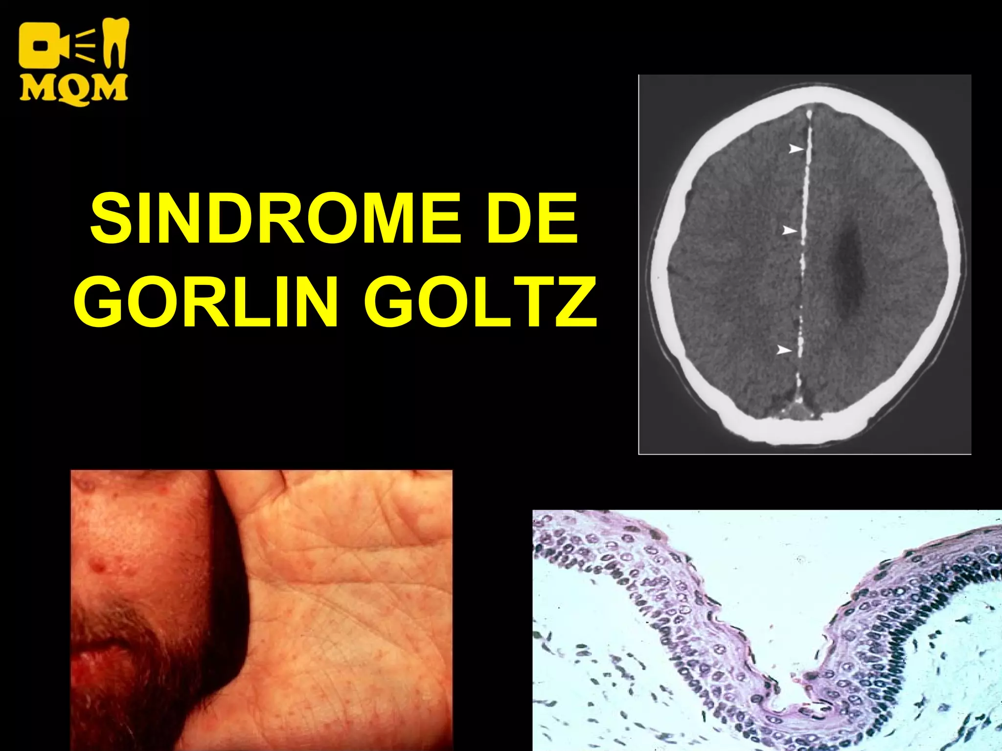 Sindrome Gorlin Goltz | PPT | Descarga Gratuita