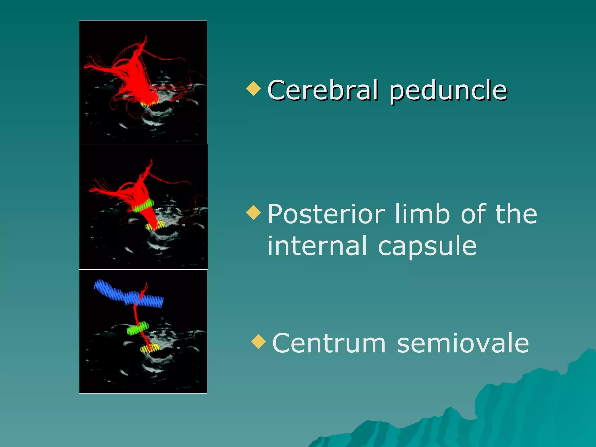 DTI Fiber Tracking | PPT